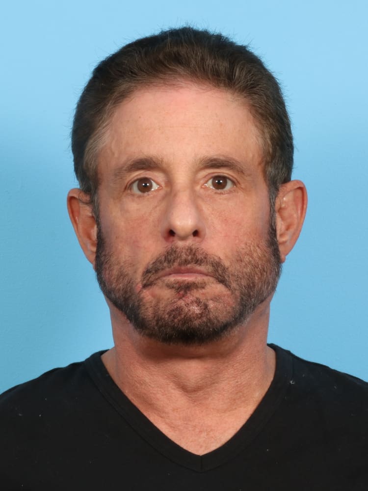 Male Facial Surgery Before and After Photo Gallery | Folsom, CA